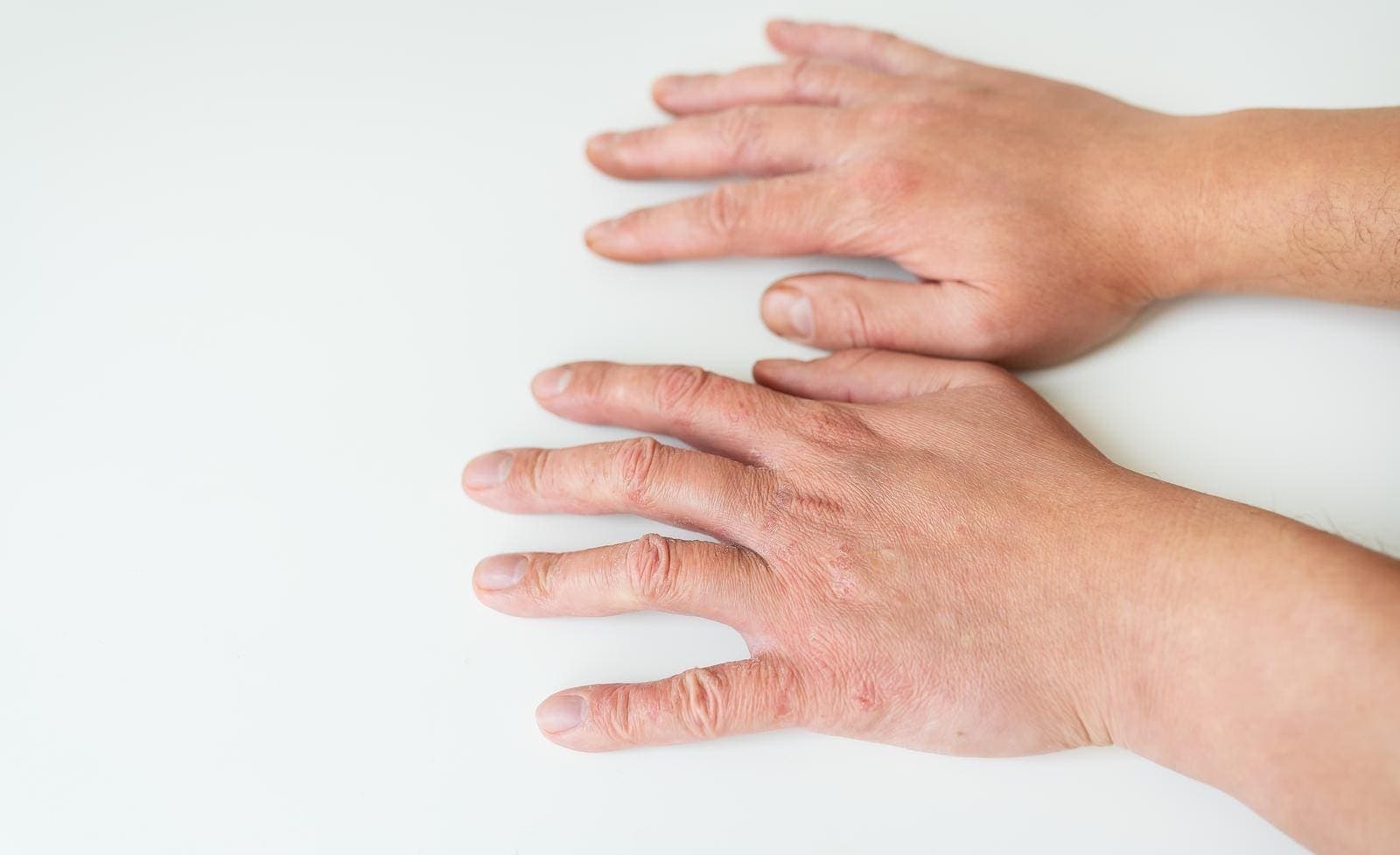 What Does It Mean When Your Palms Itch? 7 Possible Causes To Look Out For